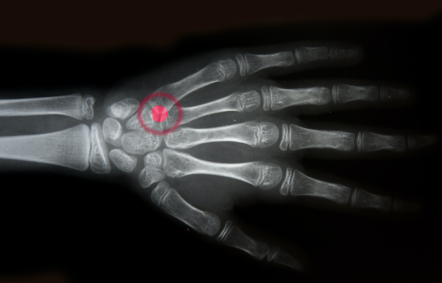 Ganglion Cyst Treatments – Jennifer Hertz, MD