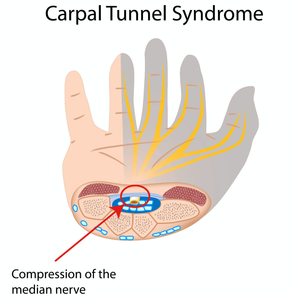 carpal tunnel syndrome treatment los angeles jennifer hertz md select ...
